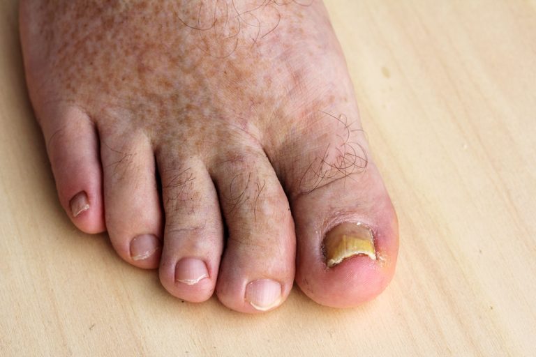 Toenail Problems: Ingrown, Fungal and Thickened Nail Treatement